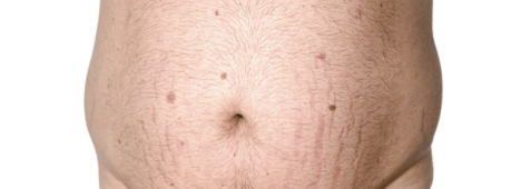 Striae: striemen op de huid | Oorzaak en tips | Sproet