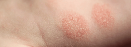 Rode vlekken op de huid | Oorzaak en mijn tips als huidtherapeut