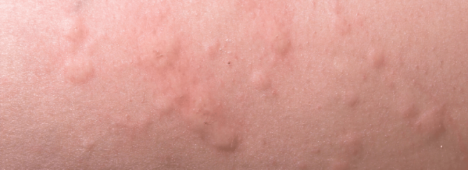 Rode vlekken op de huid | Oorzaak en mijn tips als huidtherapeut