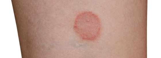 Rode vlekken op de huid | Oorzaak en mijn tips als huidtherapeut