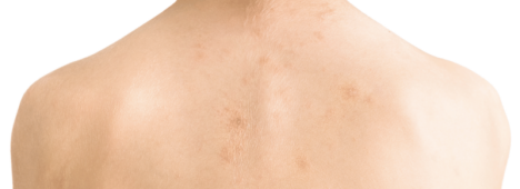 Rode vlekken op de huid | Oorzaak en tips