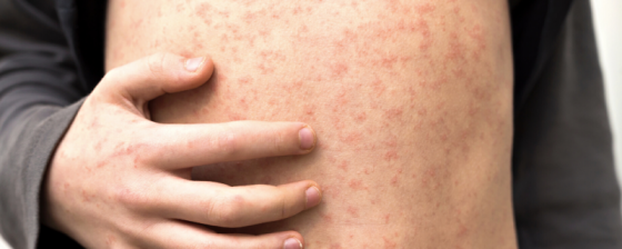 Rode vlekken op de huid | Oorzaak en mijn tips als huidtherapeut