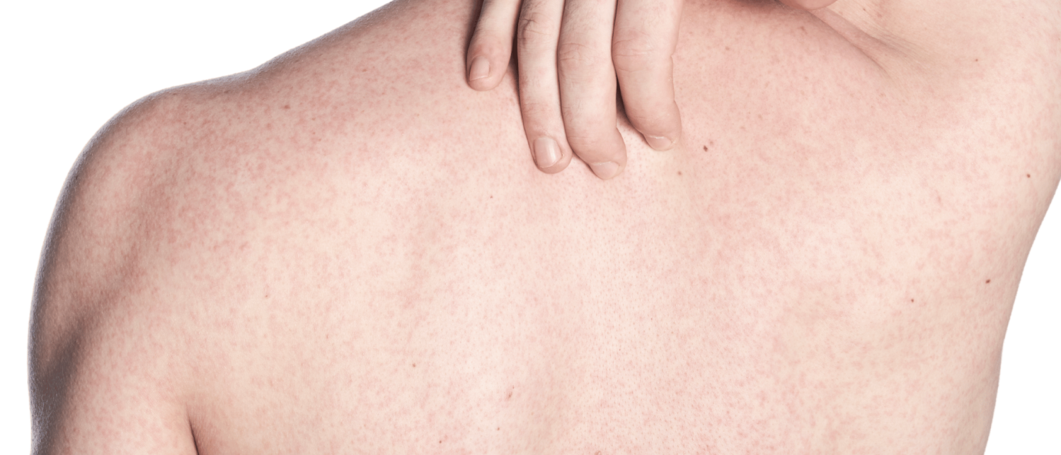 Rode vlekken op de huid | Oorzaak en mijn tips als huidtherapeut