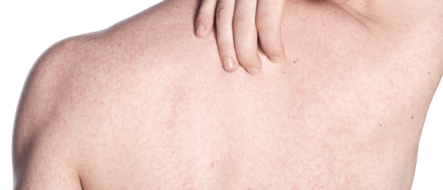 Rode vlekken op de huid | Oorzaak en mijn tips als huidtherapeut