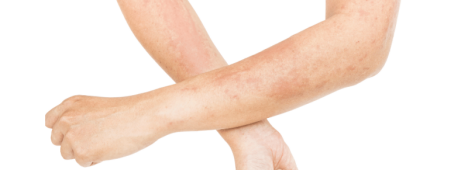 Soorten huiduitslag | Oorzaak en tips | Sproet