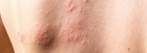 Soorten huiduitslag | Oorzaak en tips | Sproet