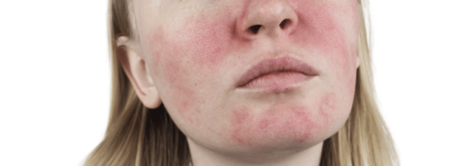 Soorten huiduitslag | Oorzaak en tips | Sproet