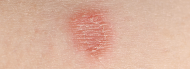 Soorten huiduitslag | Oorzaak en tips | Sproet