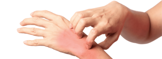 Soorten huiduitslag | Oorzaak en tips | Sproet