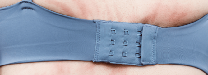 Soorten huiduitslag | Oorzaak en tips | Sproet