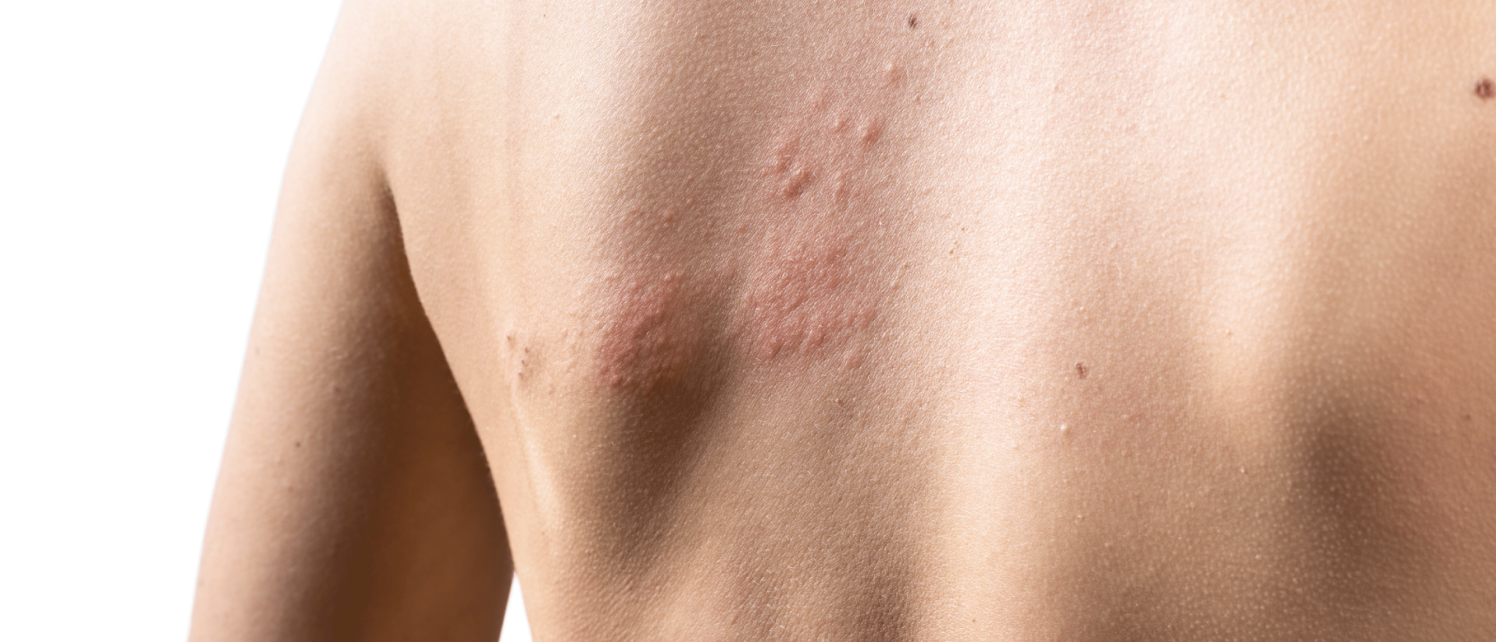 Soorten huiduitslag | Oorzaak en tips | Sproet