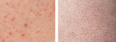 Ontstoken haarzakjes | Oorzaak en behandeling | Sproet