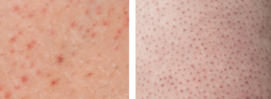 Ontstoken haarzakjes | Oorzaak en behandeling | Sproet