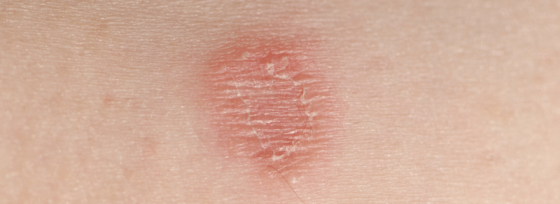 Ringworm | Oorzaak en tips | Sproet