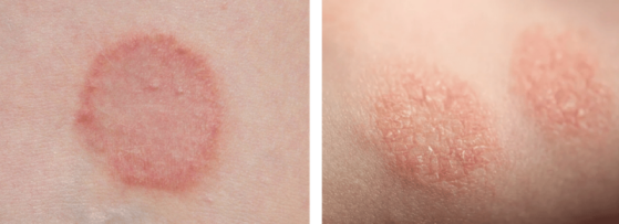 Ringworm | Oorzaak en tips | Sproet