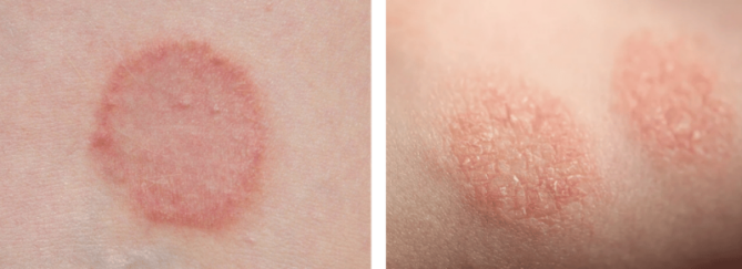 Ringworm | Oorzaak en tips | Sproet