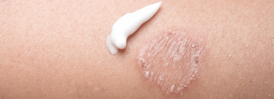 Ringworm | Oorzaak en tips | Sproet