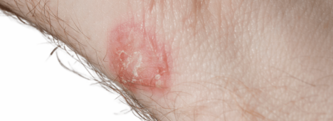 Ringworm | Oorzaak en tips | Sproet