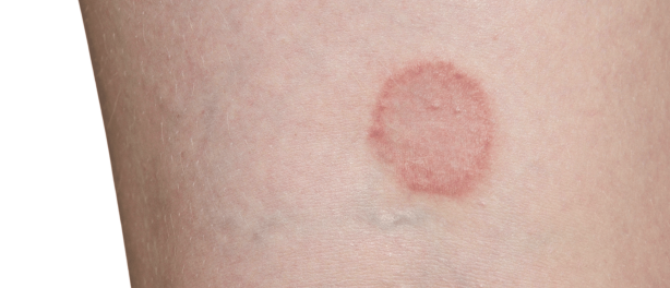 Ringworm | Oorzaak en tips | Sproet