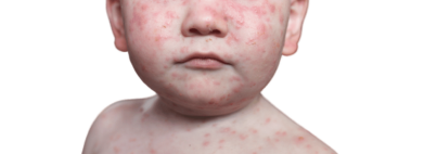 Waterpokken kind | Snel van de jeuk af!