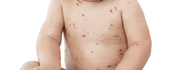 Waterpokken kind | Snel van de jeuk af!