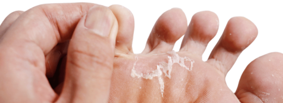 Voetschimmel | Jeuk onder voeten | Oplossing | Sproet