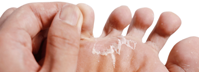 Voetschimmel | Jeuk onder voeten | Oplossing | Sproet