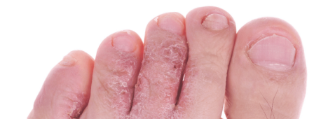 Voetschimmel | Jeuk onder voeten | Oplossing | Sproet