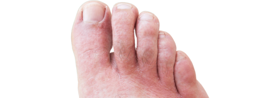 Voetschimmel | Jeuk onder voeten | Oplossing | Sproet