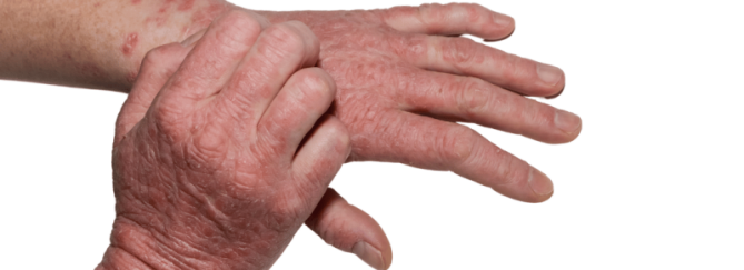 Eczeem handen | Oorzaak en oplossing | Sproet