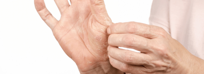 Eczeem handen | Oorzaak en oplossing | Sproet