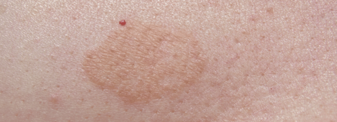 Schimmelinfecties huid | Oorzaak en behandeling | Sproet