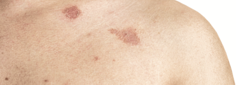 Schimmelinfecties huid | Oorzaak en behandeling | Sproet