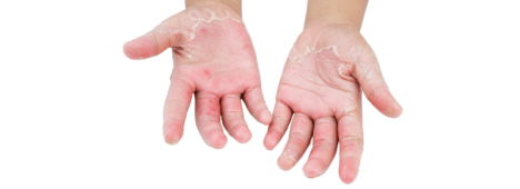 Schimmelinfecties huid | Oorzaak en behandeling | Sproet