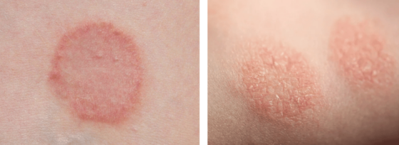 Schimmelinfecties huid | Oorzaak en behandeling | Sproet