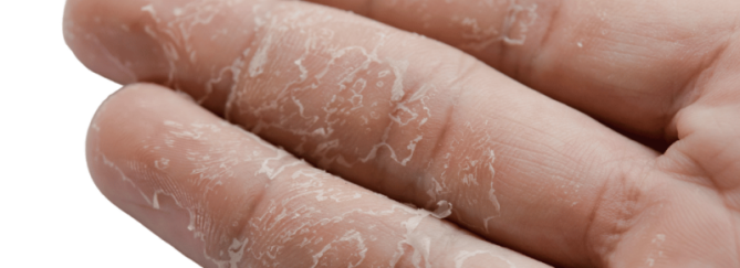 Handschimmel | Oplossing en behandeling | Sproet