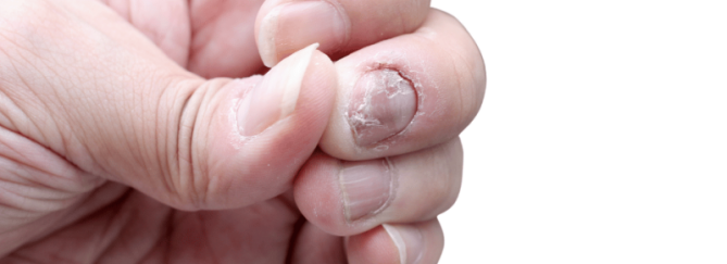 Handschimmel | Oplossing en behandeling | Sproet