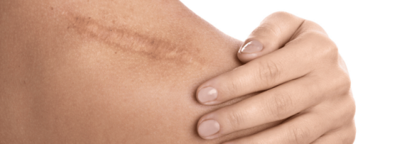 Atrofisch litteken | Oorzaak en behandeling | Sproet