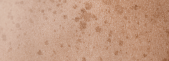 Pityriasis rosea | Rode vlekjes lichaam | Sproet