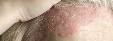 Hoofdhuid psoriasis | Oorzaak en tips | Sproet