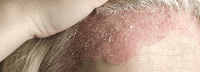 Hoofdhuid psoriasis | Oorzaak en tips | Sproet