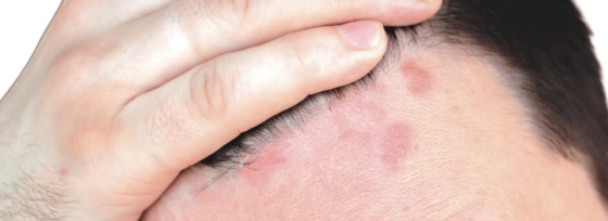 Hoofdhuid psoriasis | Oorzaak en tips | Sproet