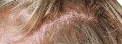 Hoofdhuid psoriasis | Oorzaak en tips | Sproet