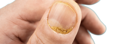 Hoofdhuid psoriasis | Oorzaak en tips | Sproet