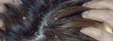 Hoofdhuid psoriasis | Oorzaak en tips | Sproet