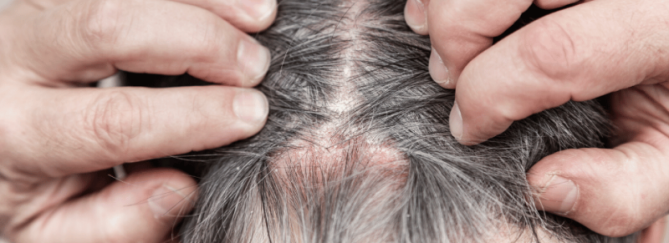 Hoofdhuid psoriasis | Oorzaak en tips | Sproet