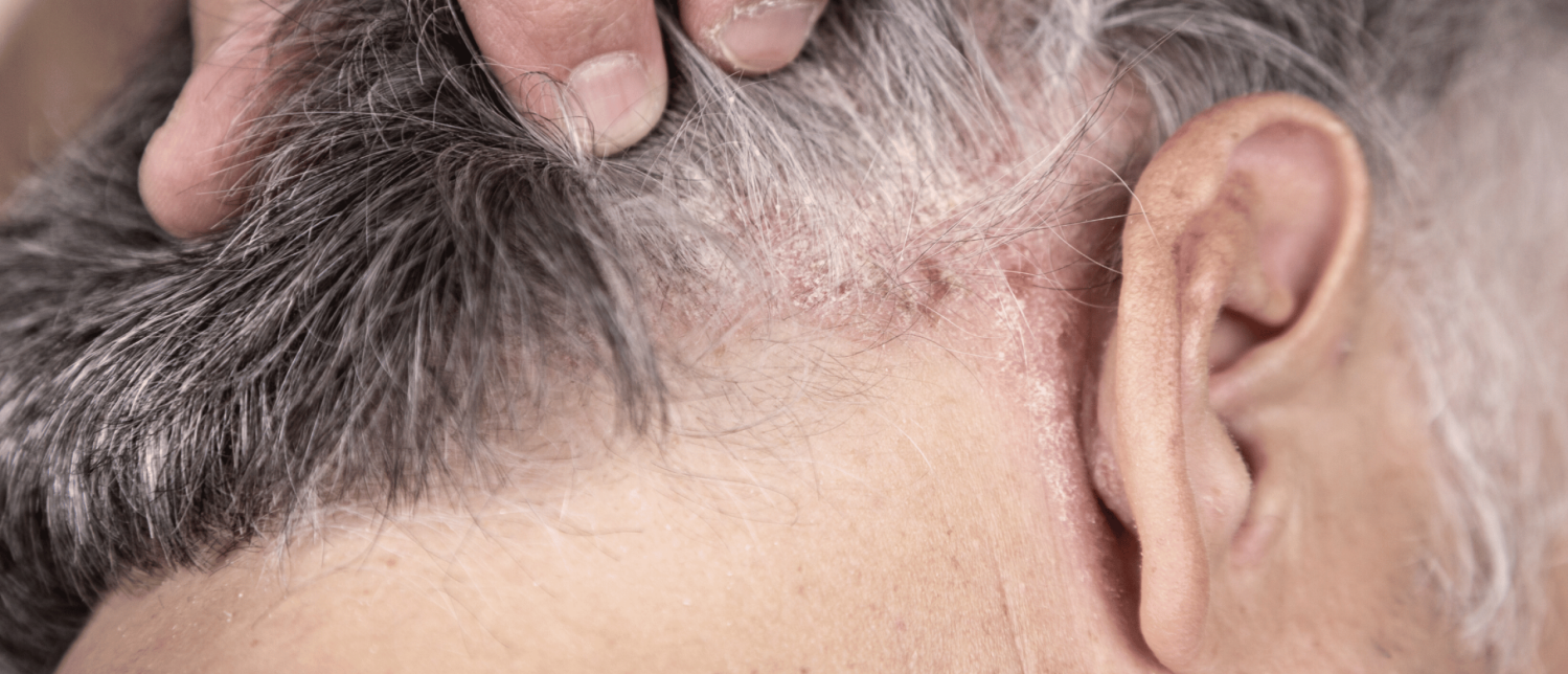Hoofdhuid psoriasis | Oorzaak en tips | Sproet