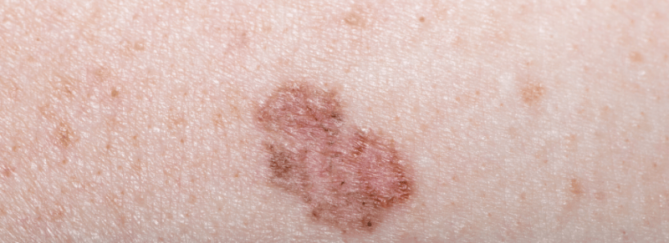 Basaalcelcarcinoom | Huidkanker | Sproet