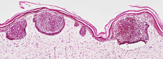 Basaalcelcarcinoom | Huidkanker | Sproet