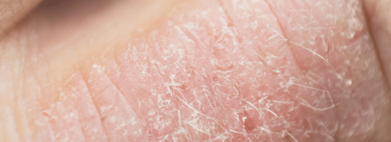 Voet eczeem | Oorzaak en tips | Sproet